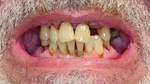 Implantes y dientes fijos en 24h - IOC Clínica Dental | Clínicas ...