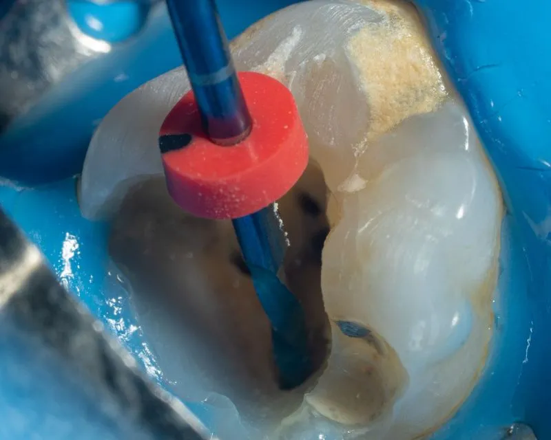 Tratamientos Endodoncia Mecánica y Microscópica | IOC Clínica Dental