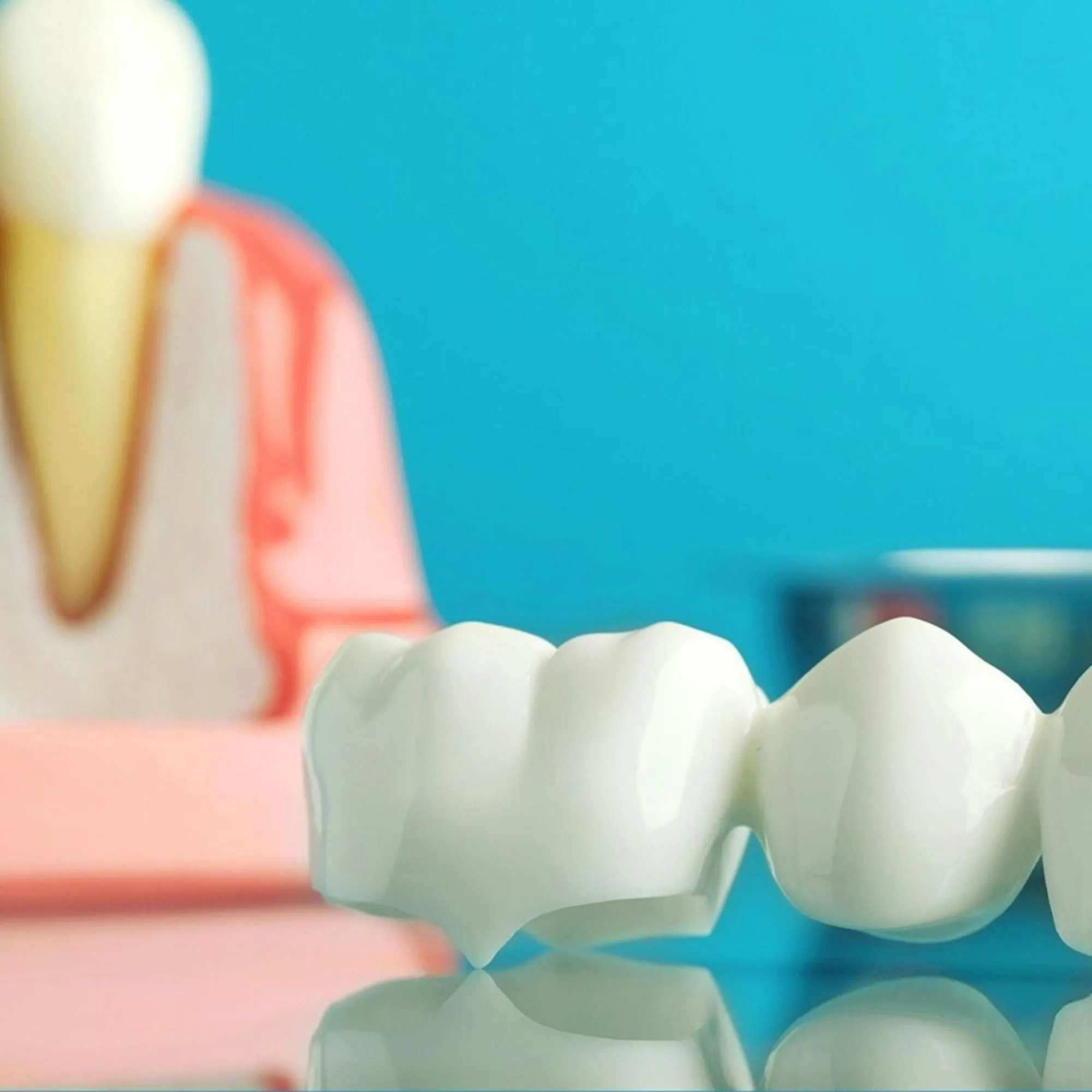 ¿Es posible poner implantes y dientes fijos en 24 horas? [VÍDEO]
